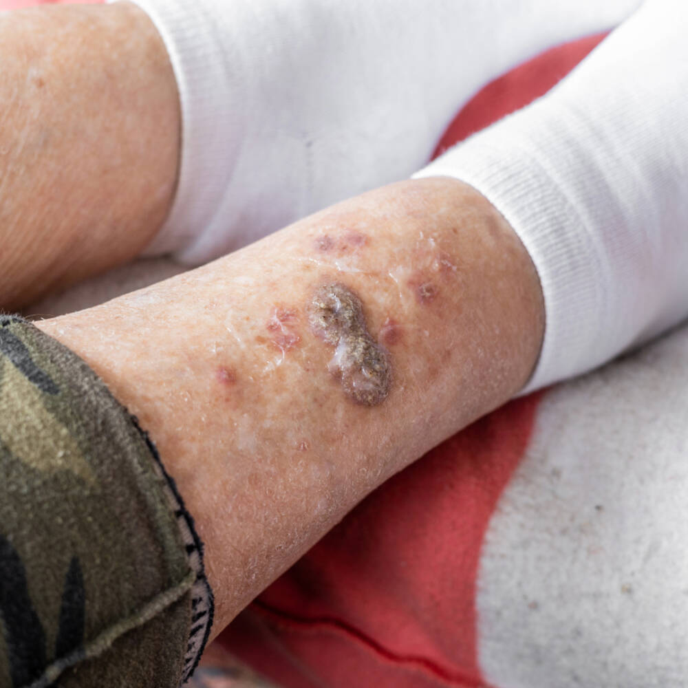 Understanding Pressure Ulcers: Prevention and Treatment